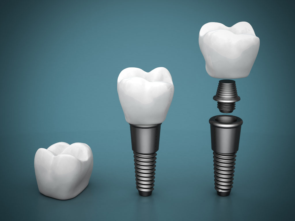 Understanding the Dental Implant Process | Dental Implants Miami Beach